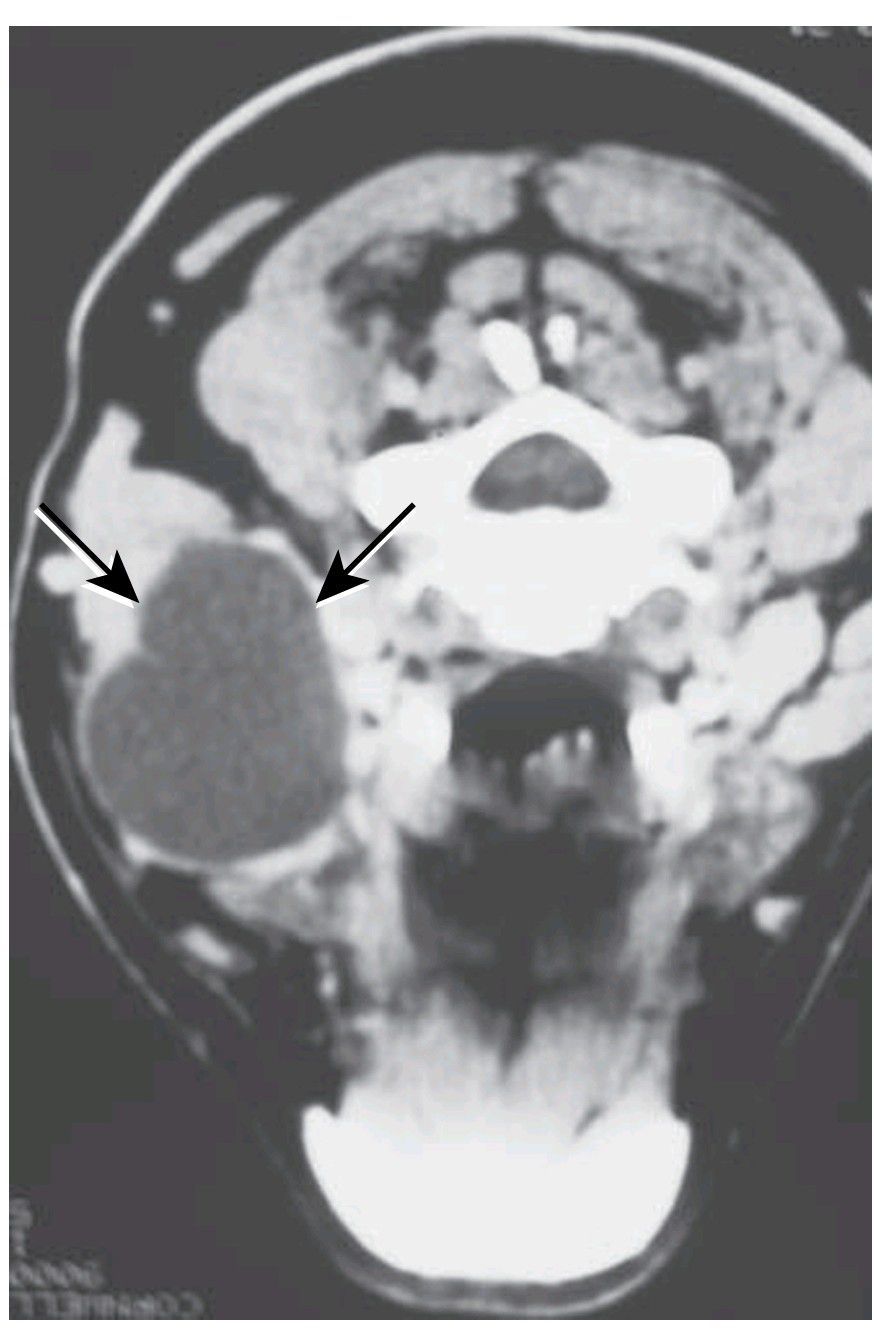 Cervical lymphoepithelial cyst (radiograph) - MEDizzy