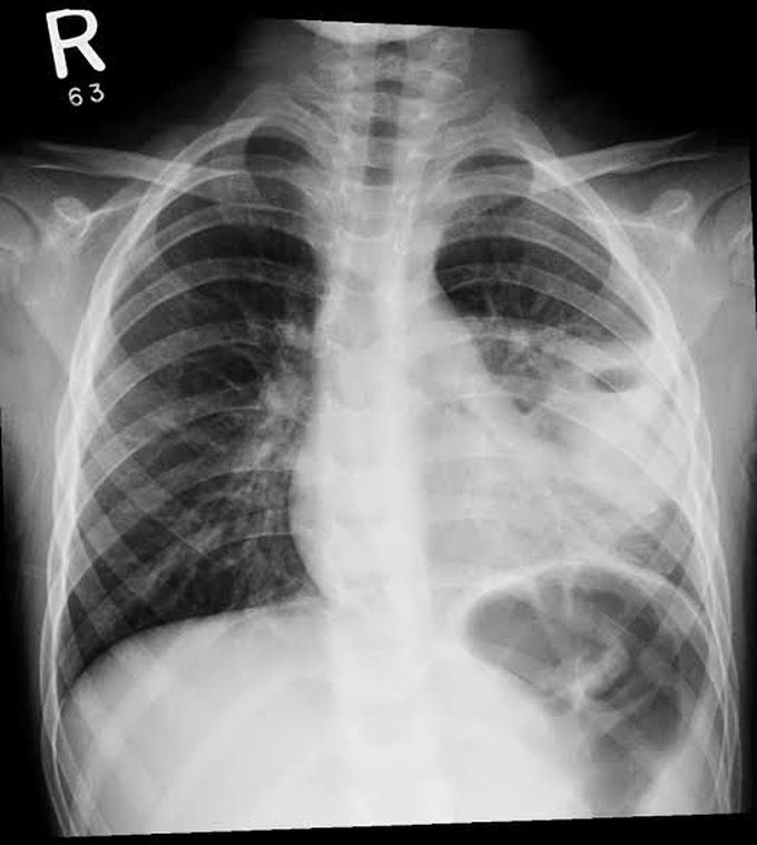 Lung Abscess - MEDizzy