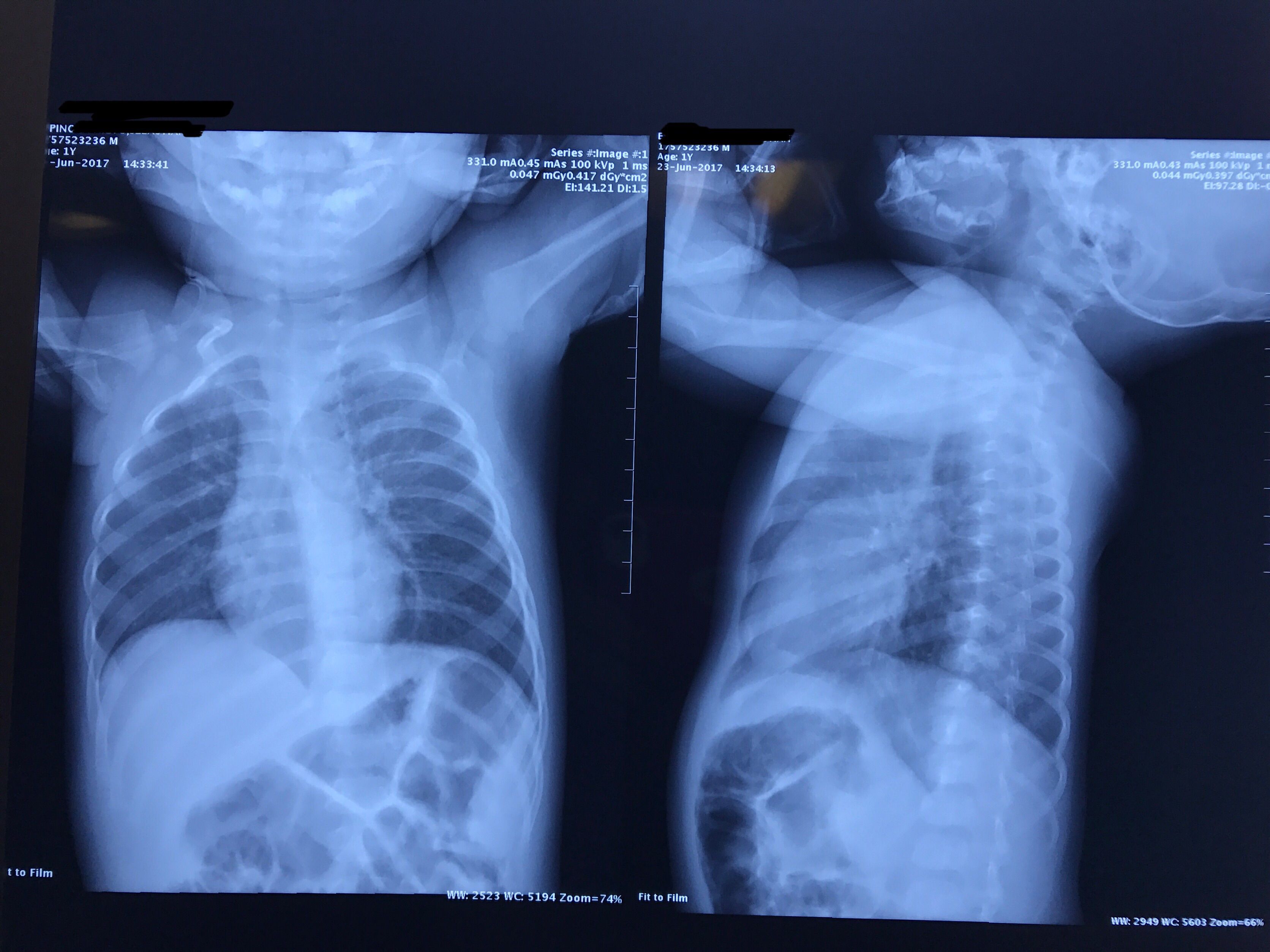 Radiografía De Crup NUEVOS CONCEPTOS DE LA LARINGOTRAQUEÍTIS EN