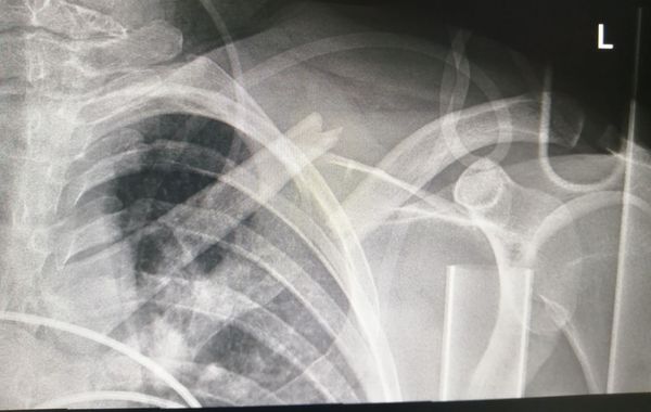 Clavicle AP View