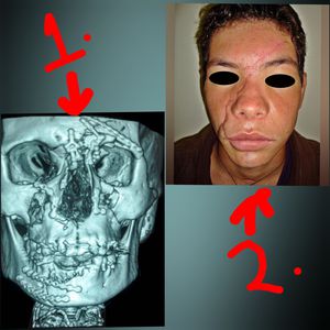 Case sequence (maxillofacialsurgery) - MEDizzy