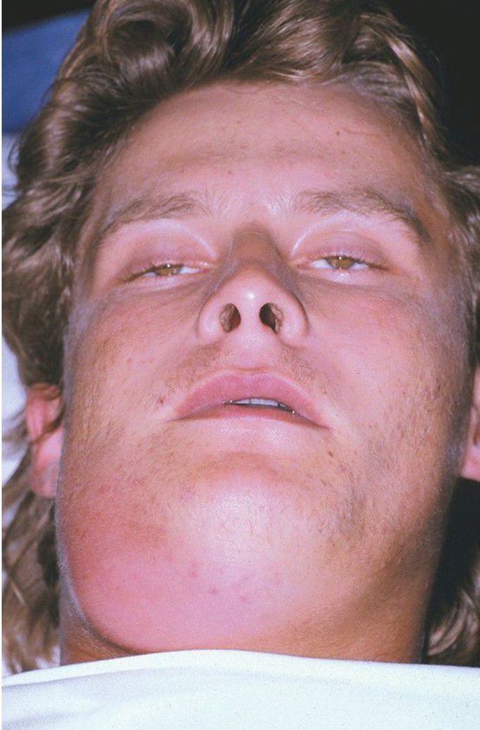 Ludwig Angina - MEDizzy