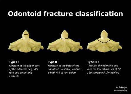 Odontoid Fracture classification - MEDizzy