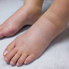 What is edema? - MEDizzy