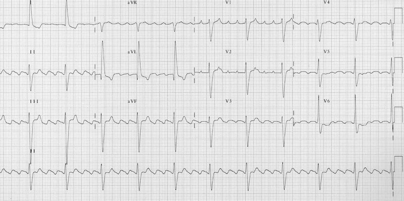 Atrial Flutter Litfl Ecg Library Diagnosis An Irregularly Irregular