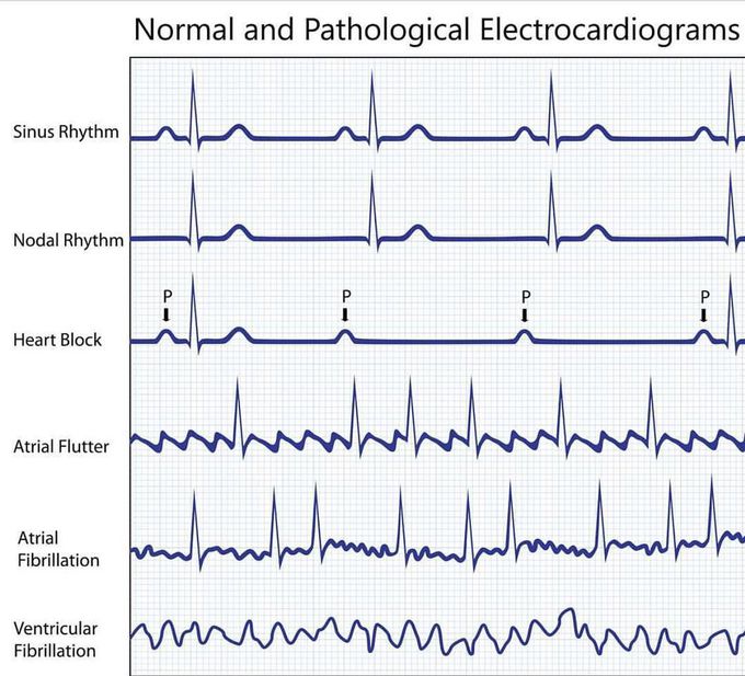 Abnormal ECG MEDizzy
