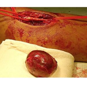 Arterovenous (AV) Fistula Salvage with Artegraft - MEDizzy