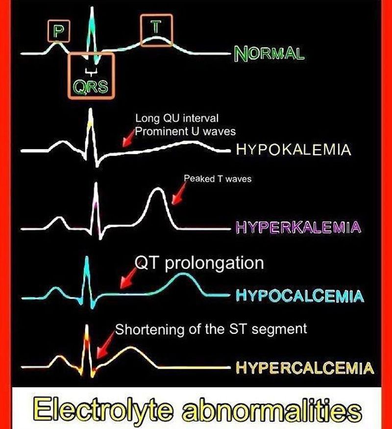 Hypokalemia Ecg