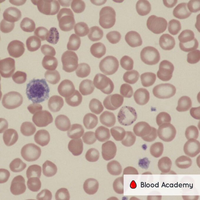 A 12 year Old Boy Known To Have Beta Thalassemia Trait MEDizzy