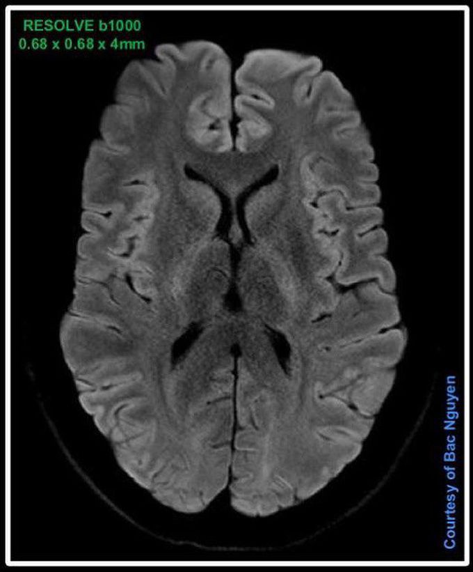 RESOLVE DWI @ Siemens Check this paper for a better - MEDizzy
