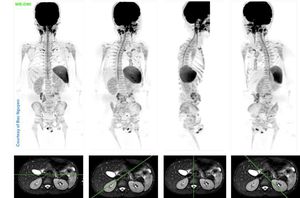 Whole Body DWI @ Siemens 1.5T Aera. Acquired in direct - MEDizzy