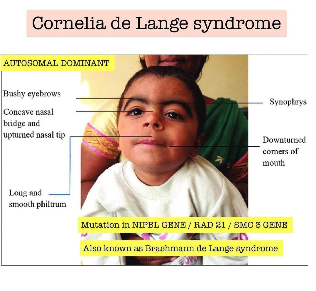 Cornelia De Lange Syndrome Karyotype
