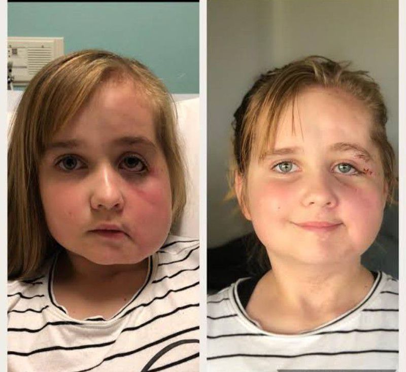 Severe Parry Romberg Syndrome