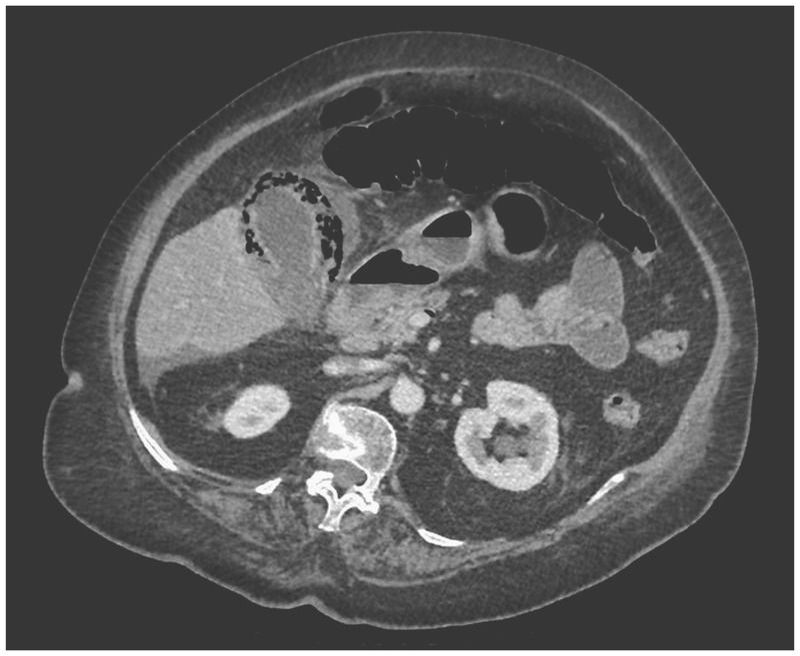 Emphysematous Cholecystitis - MEDizzy