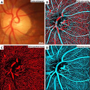 Posterized Posterior Segment. Optic nerve head and - MEDizzy