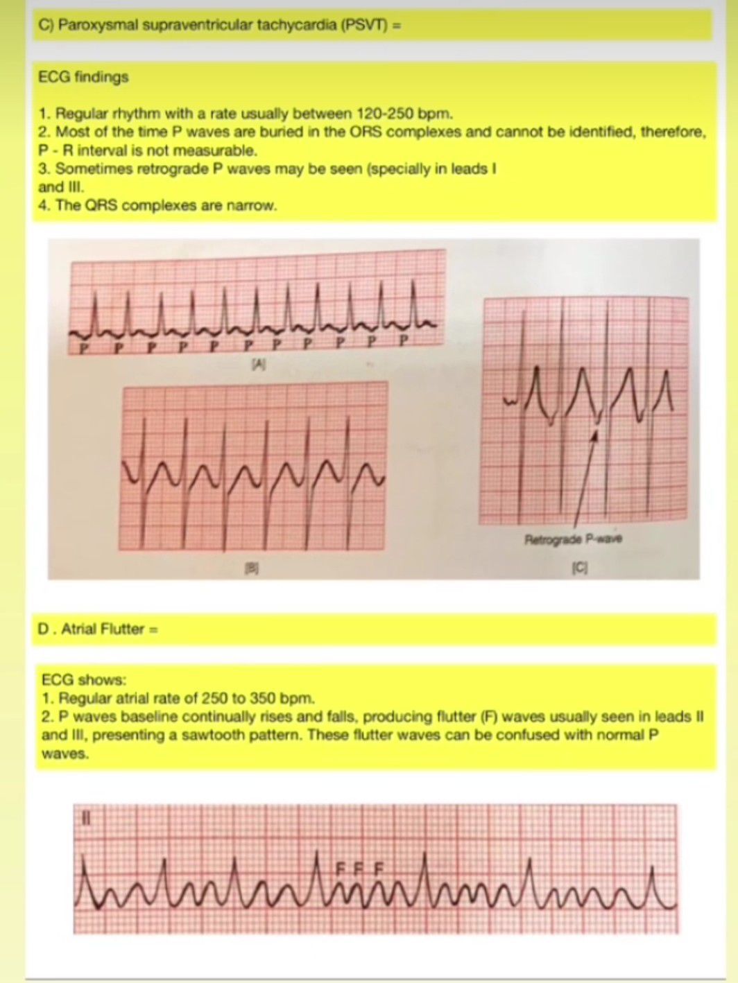 PSVT And Atrial Flutter MEDizzy