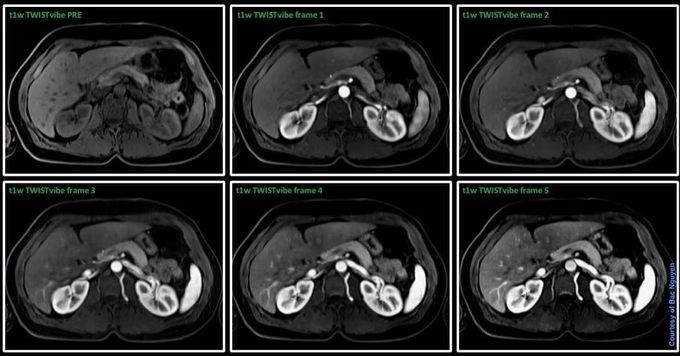 MR Abdominal Imaging – Usefulness of TWISTVibe @ Siemens 3T - MEDizzy