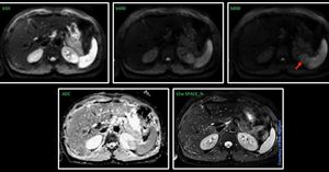 MR Abdominal Imaging – Diffusion Weighted Imaging (DWI) @ - MEDizzy