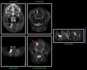 MRI metal reduction artifacts @ Siemens 1.5T Avanto Keep in - MEDizzy