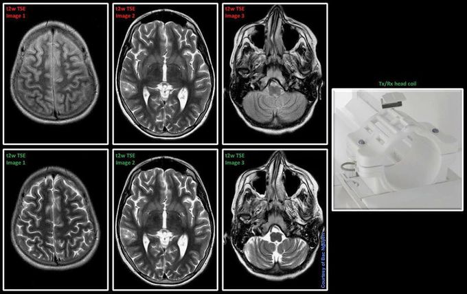 MRI Neuro Imaging – Tx/Rx head coil @ Siemens 1.5T - MEDizzy