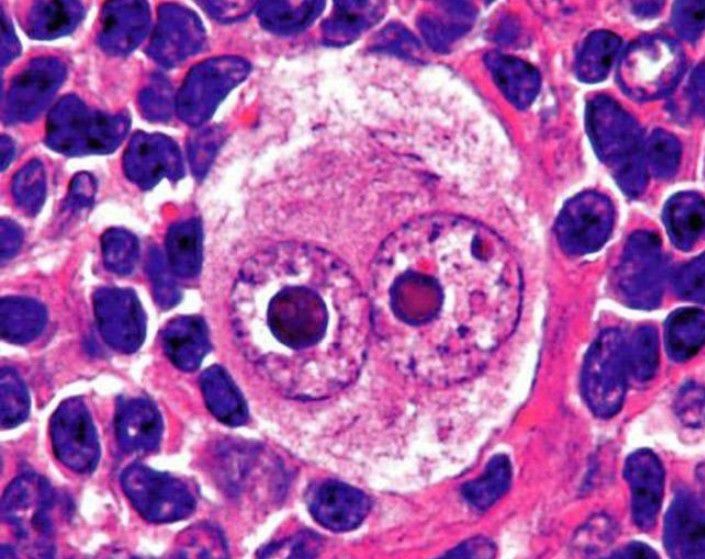 Reed sternberg cells - MEDizzy