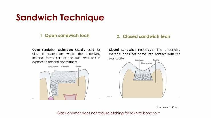 Sandwich Technique - MEDizzy