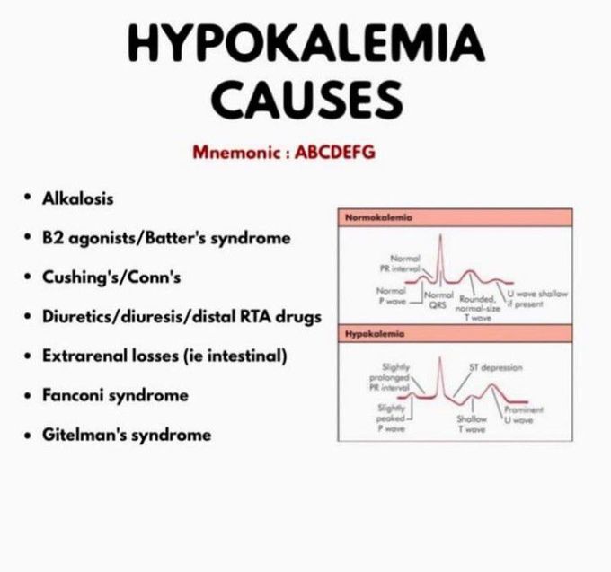 Hypokalemia-causes - MEDizzy