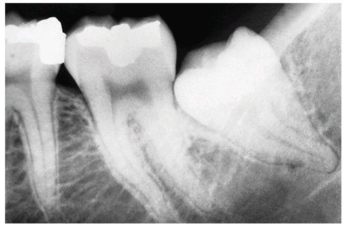 Impacted tooth - MEDizzy