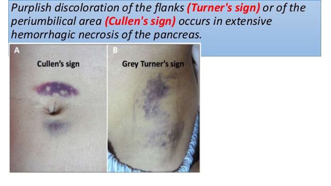 Cullens Sign Pancreatitis