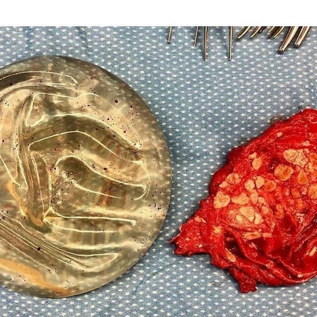 implants after 20 years