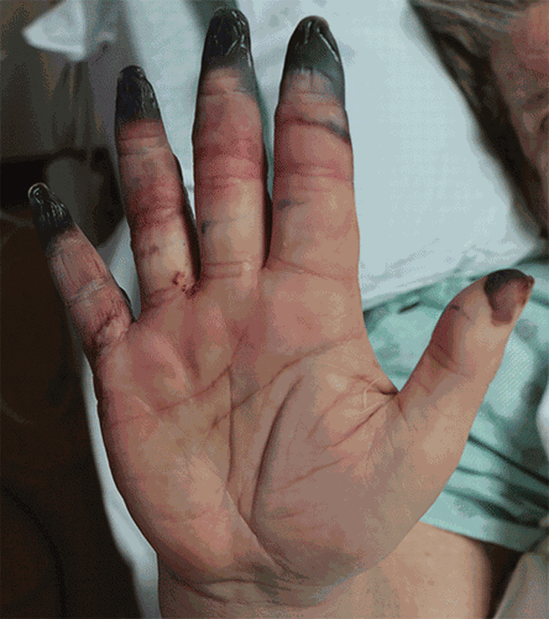 First Degree Frostbite