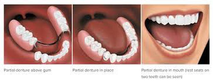 REMOVABLE PARTIAL DENTURE - MEDizzy