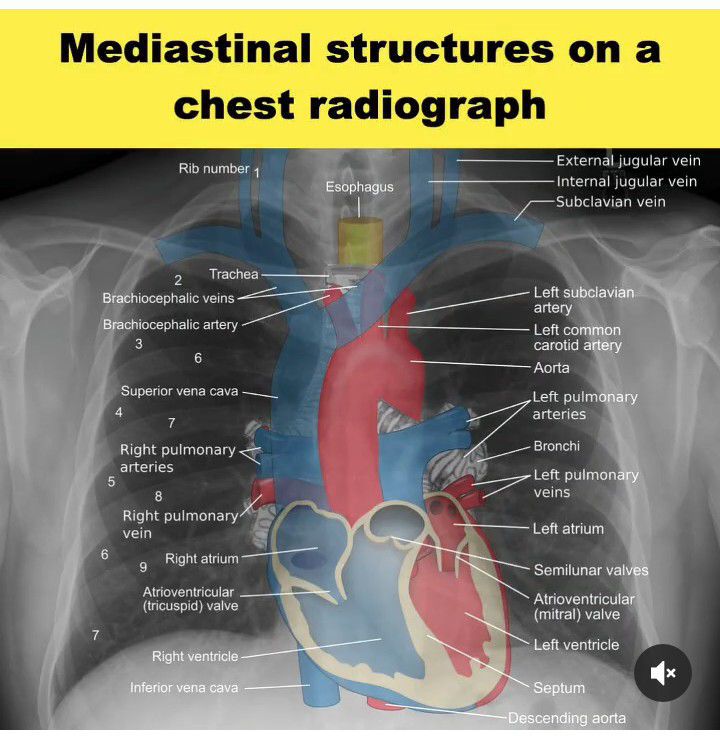 Mediastinal structures on chest radiograph - MEDizzy