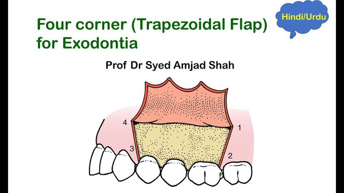 Four cornered flap - MEDizzy