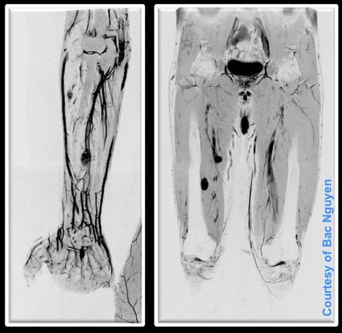 MR Neurograhpy @ Siemens 1.5T Aera#Siemens_MRI #mri - MEDizzy