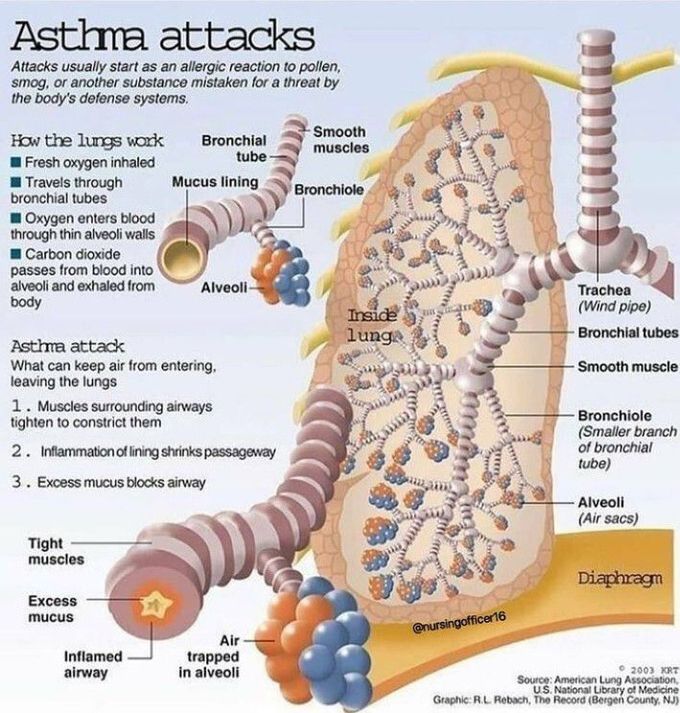 Asthma attacks - MEDizzy