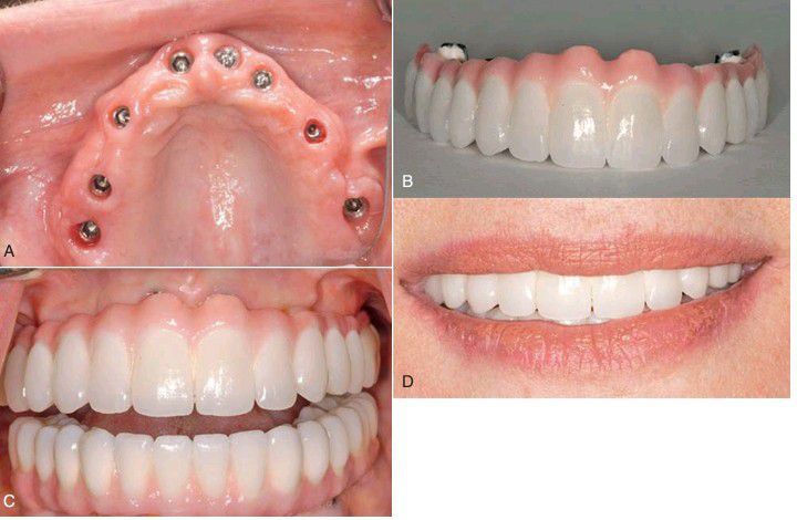 Treatment of edentulous maxilla with fixed-implant–supported - MEDizzy