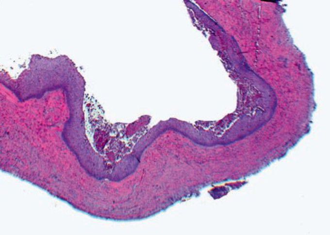 Periapical Cyst Histology Dental Update Odontogenic Cysts – An