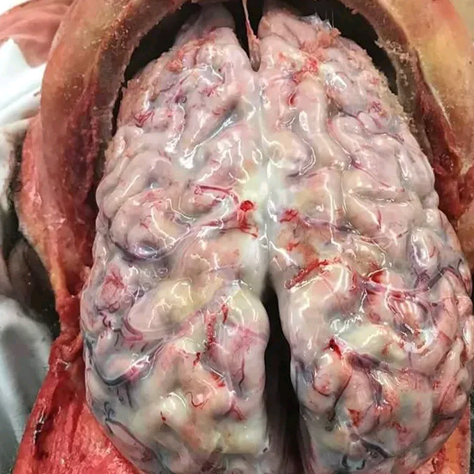 Bacterial meningitis - MEDizzy