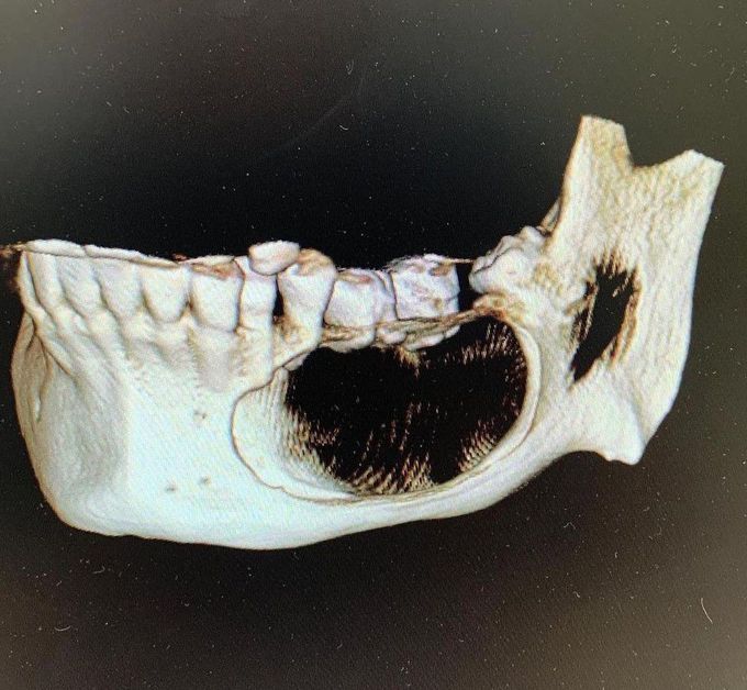 Unicystic Ameloblastoma - MEDizzy