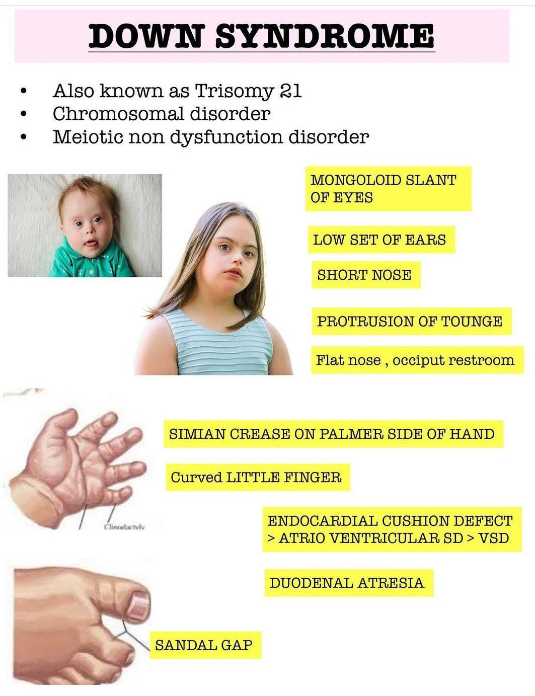 Endocardial Cushion Defect In Down Syndrome