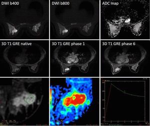 High resolution MR Imaging of the breast in a patient with - MEDizzy