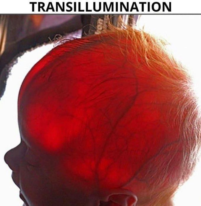 brain of a baby - MEDizzy