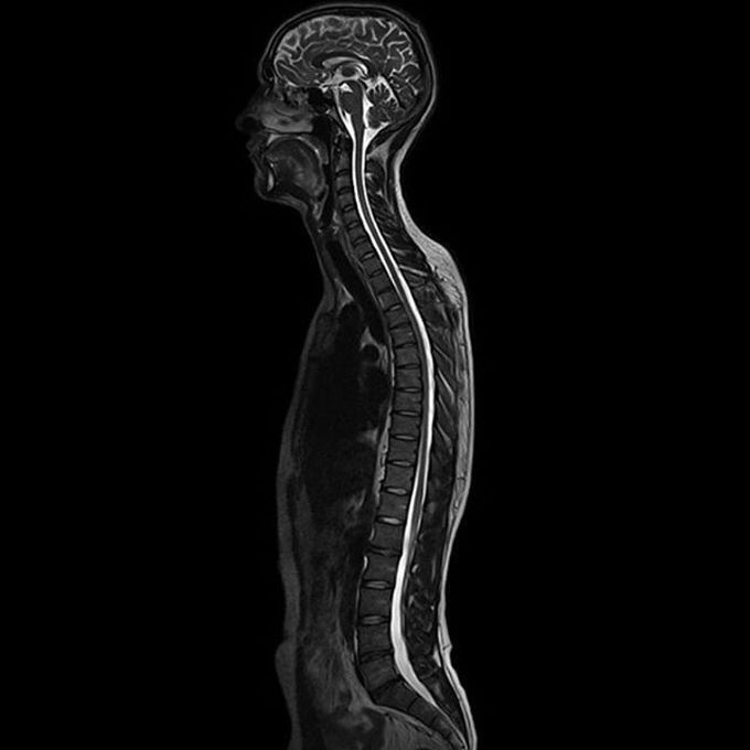 Composed sagittal T2-W TSE whole-spine examination. - MEDizzy