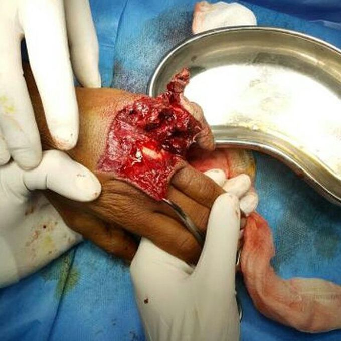 Part 1: Syrian refuge victim by gun shot to his left hand, - MEDizzy