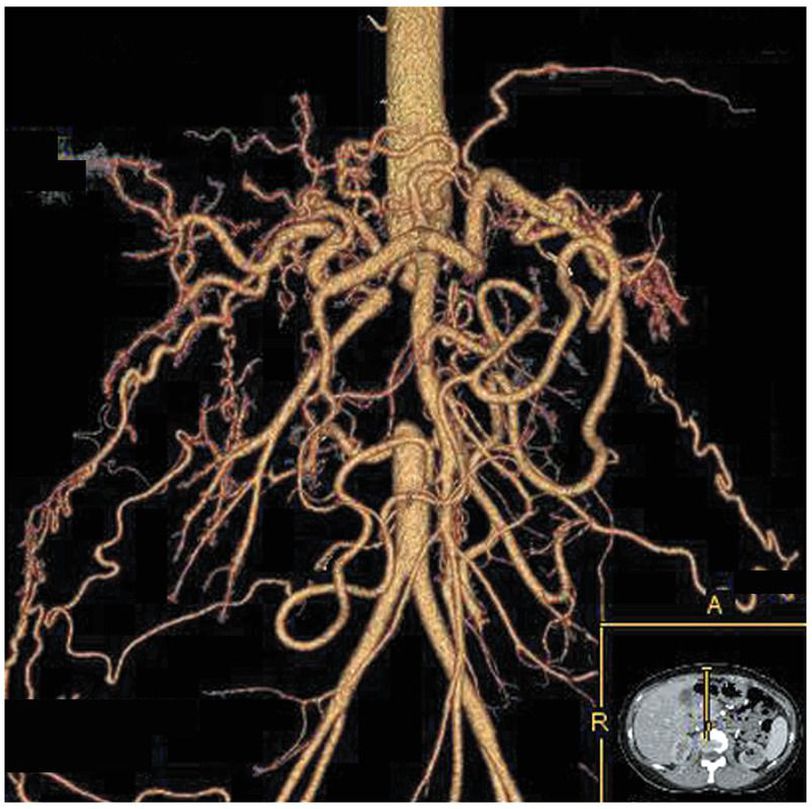 Takayasu’s Arteritis - MEDizzy