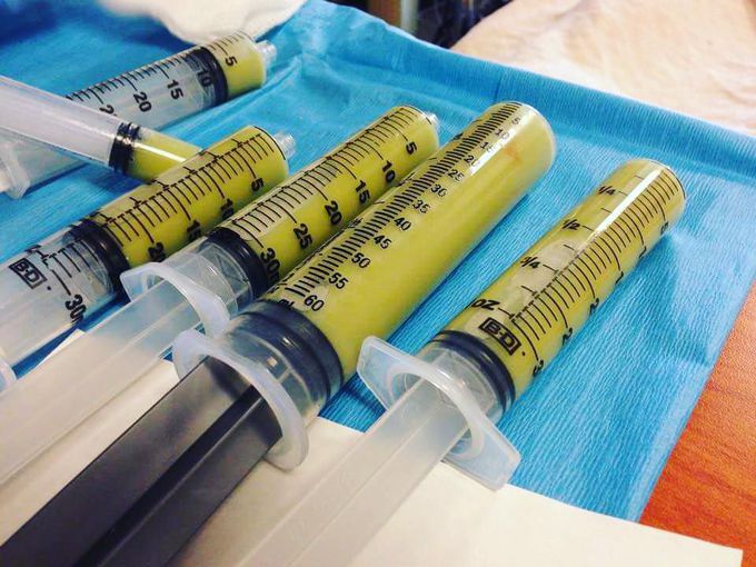 These samples were taken from the pericardium. whats your - MEDizzy