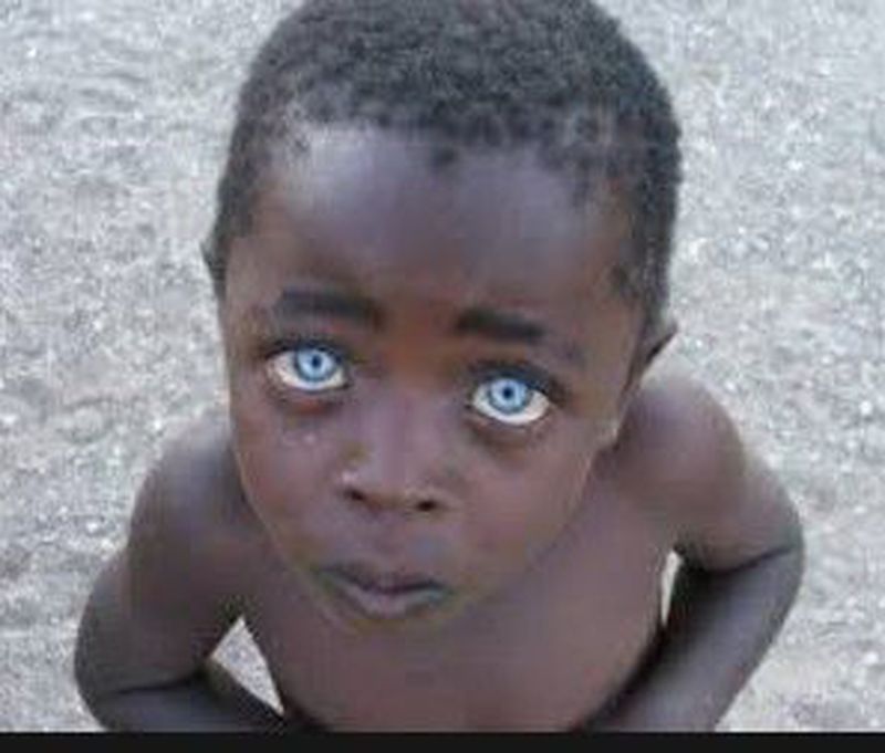 Partial Ocular Albinism