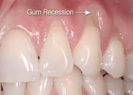 Gingival recession - MEDizzy