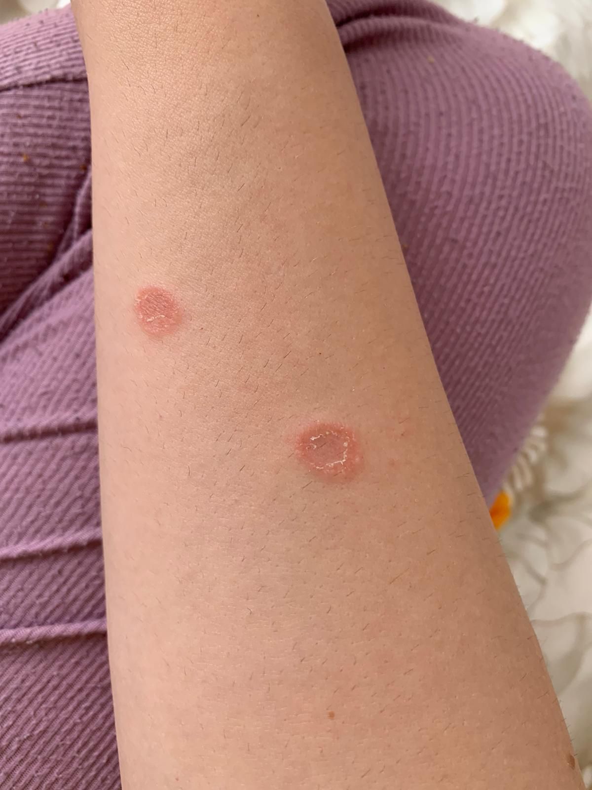Small Red Spots On Arms